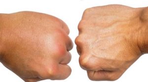 ¿Qué es la anasarca? Causas y síntomas - Portal Salud