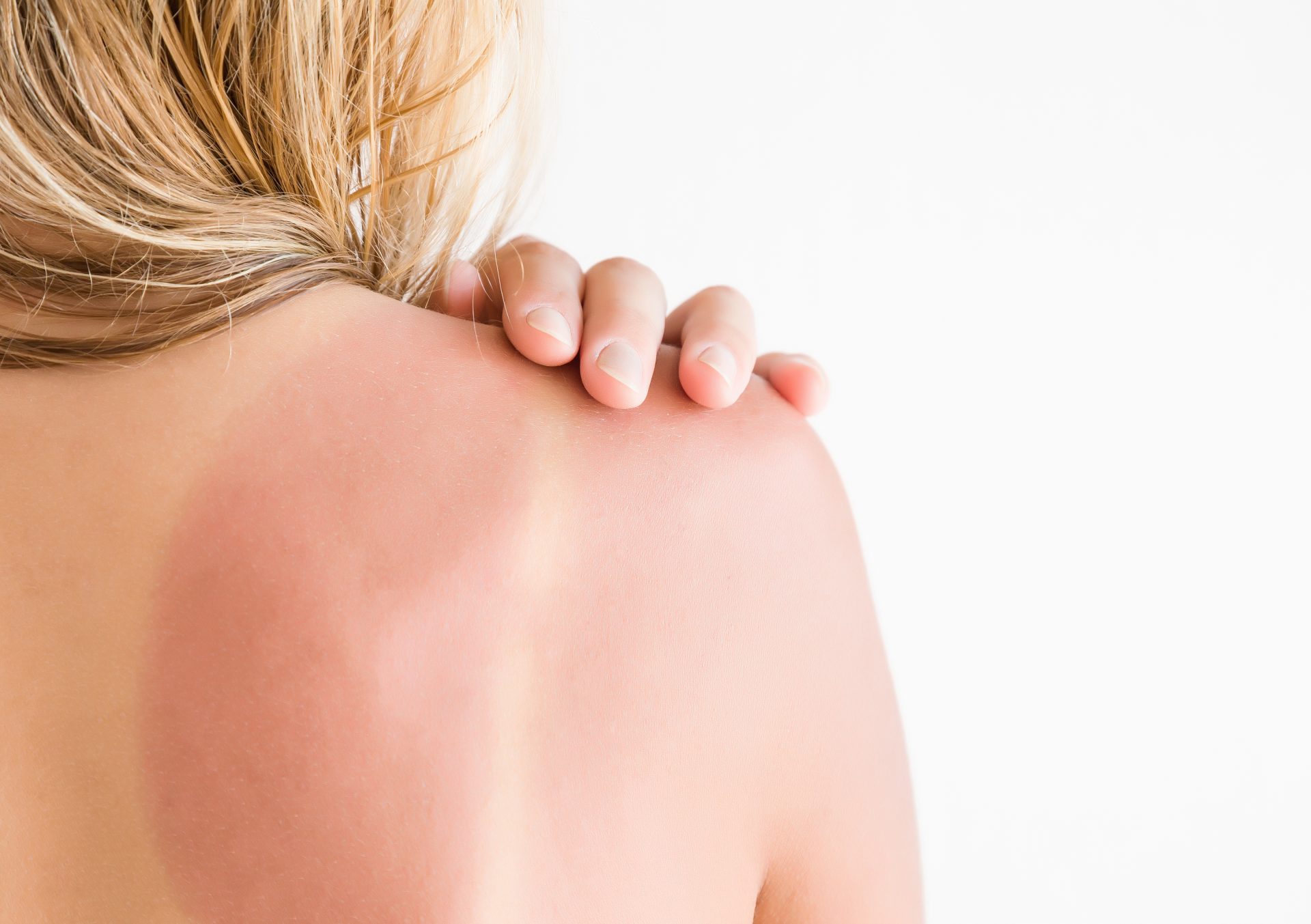 Qué hacer ante quemaduras solares intensas - Portal Salud